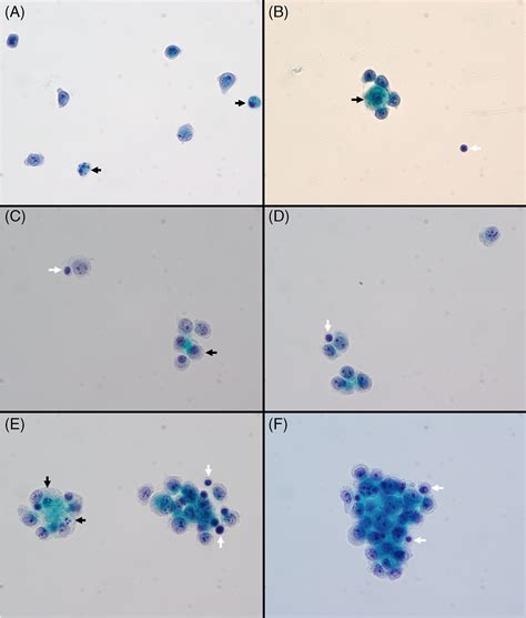 Acute Monoblastic Myeloid Leukemic Pleural Effusion Pitfalls And Clues Abdullgaffar 2023