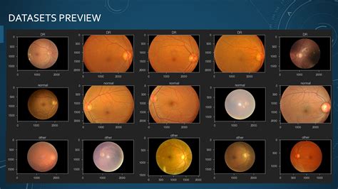 diabetic retinopathy detection using cnn architectures and augmented