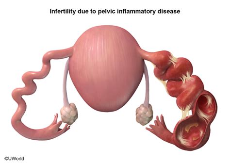 Acute Cervicitis Gynecology Uworld Medical Library