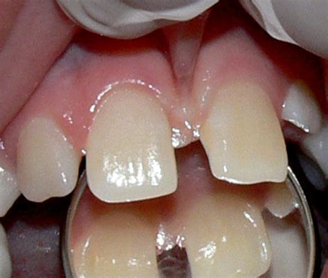 Etiology And Treatment Of Midline Diastema Directorio Odontológico