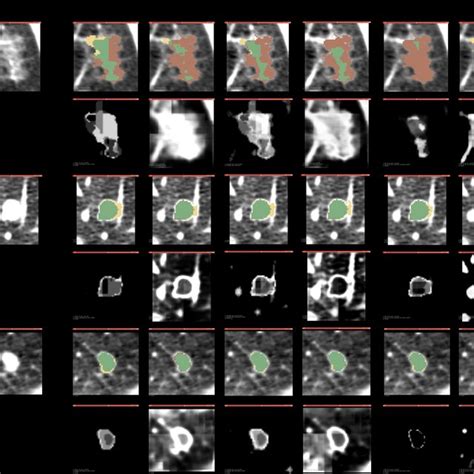 Segmentation Predictions Green True Positive Yellow False Positive