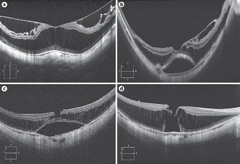 A Progressive Retinoschisis B Retinoschisis And Foveal Detachment With