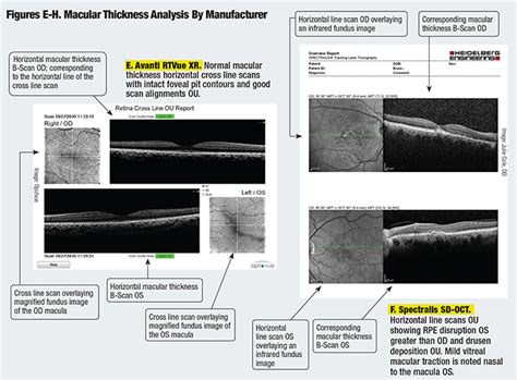 Normal Macula Oct