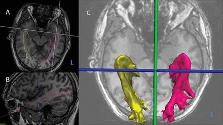 Meyers Loop Asymmetry And Language Lateralisation In Epilepsy