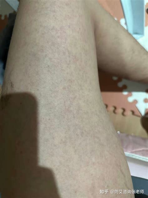 请问这是hiv急性期皮疹吗？ 知乎