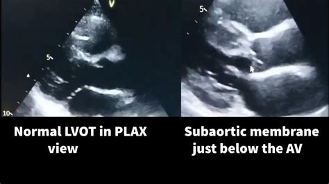 Subaortic Membrane Stenosis Youtube