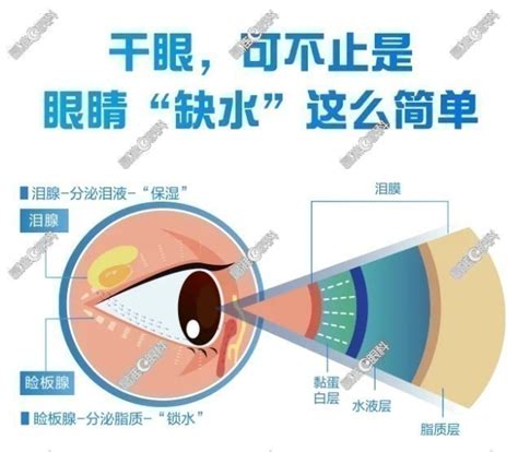 泪破5秒是重度干眼症吗是 看轻中重度干眼症如何区分 治疗 干眼症 晶准眼科