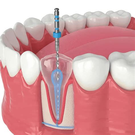 Tratamientos De Conducto Mi Endodoncia