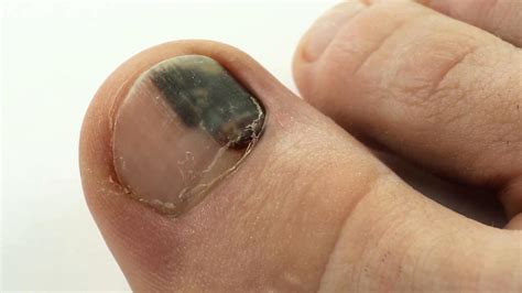 Runners Toe And How To Treat It
