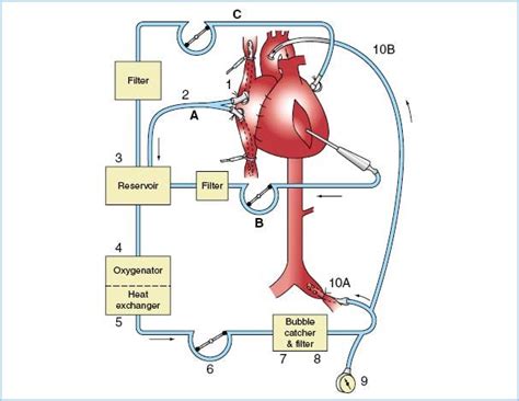 Cardiopulmonary Bypass Cannulation Open Seldinger Technique In