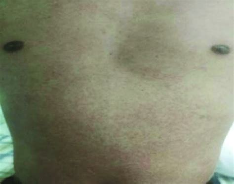 Red Rash Papules On The Trunk Download Scientific Diagram