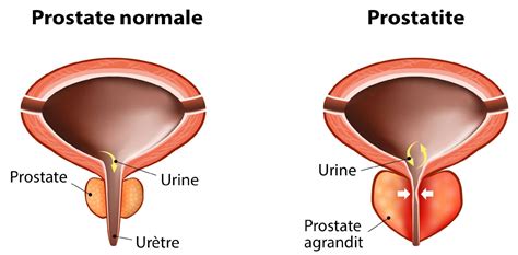 La Prostatite Symptômes Et Traitements Information Hospitalière