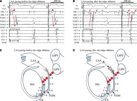 Mitral Isthmus Ablation Circulation Arrhythmia And Electrophysiology