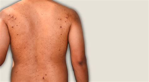 Steroid Injection For Keloid Singapore At Harry Leslie Blog
