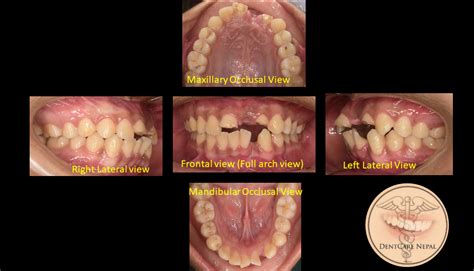 Dentosphere World Of Dentistry Some Sample Intraoral Photograph In