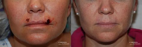 Skin Cancer Reconstruction Face Before And After Gallery