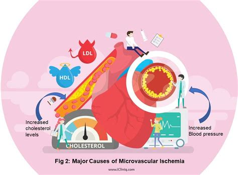 Microvascular Ischemic Disease Symptoms Causes Diagnosis Treatment Prevention
