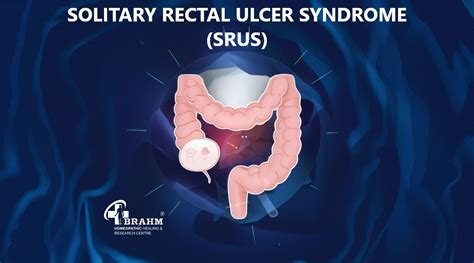 Solitary Rectal Ulcer Syndrome Treatment In Homeopathy Symptoms Of