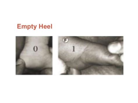 Ctev Imaging Classification Pirani Scoring System Conservative