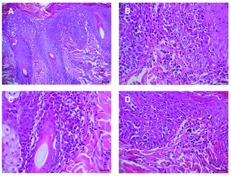 Histopathologic Features Of Dle A Interface Dermatitis Bar 75 µm