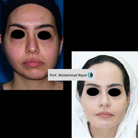 Dr Mohammad Bayat On Linkedin Bimax And Genioplasty Surgery