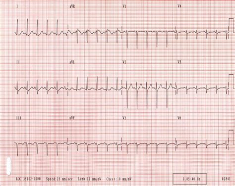 Tachycardia Sinus Sinus Tachycardia