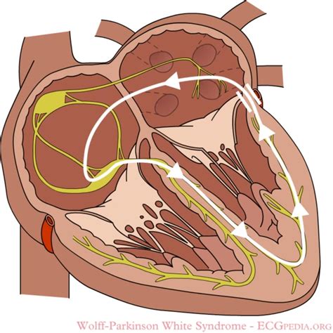 Wolff Parkinson White Syndrome Is Exercise Stress Testing A