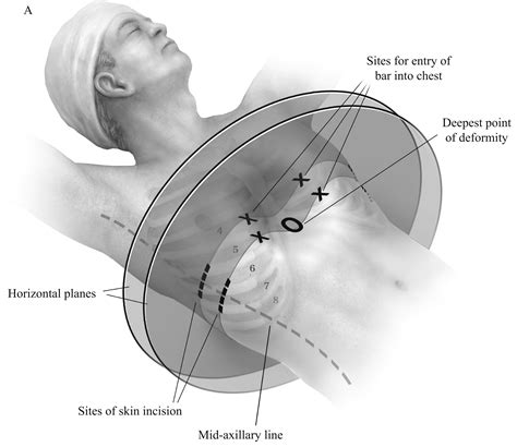 The Minimally Invasive Repair Of Pectus Excavatum Operative