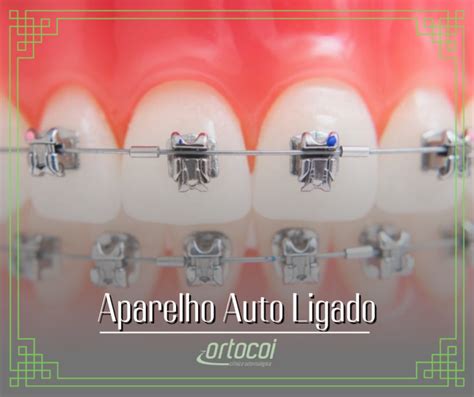 Aparelho Auto Ligado O Que é Ortocoi Clínica Ortodôntica