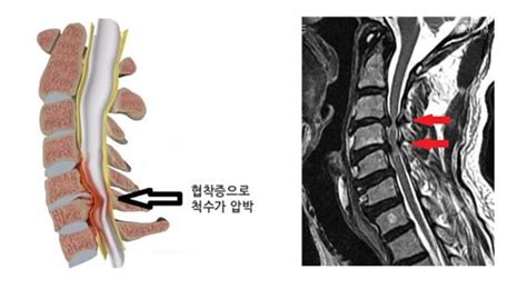 창원메트로병원 경추부 척추관 협착증 척추관절기타질환정보 메트로병원