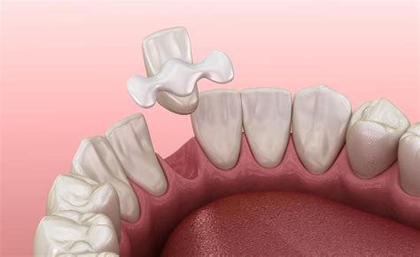 Dental Bridges Comprehensive Guide To Types Costs And Care — Nova Smiles