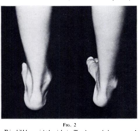 Figure 2 From Split Posterior Tibial Tendon Transfer In Spastic Cerebral Palsy Semantic Scholar