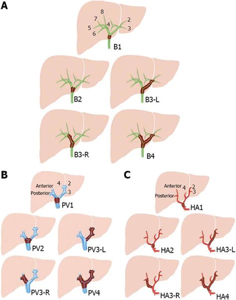 Klatskin Tumor Stages Of