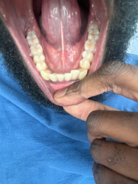 How Long Will It Take To Realign After Wisdom Teeth Are Taken Out R