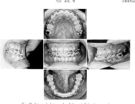Figure 1 From A Case Of Skeletal Mandibular Prognathism With Maxillary Under Growth Treated By