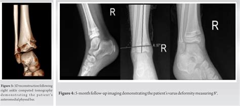Spontaneous Resolution Of Pediatric Varus Ankle Deformity A Case