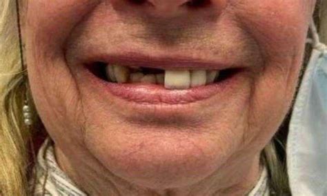 Two Front Teeth Implants Before And After Photos Manchester Nh