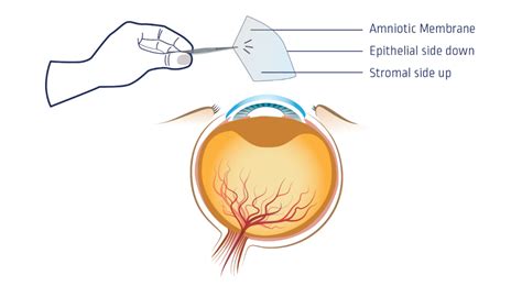 Amniomatrix Amniotic Membrane For Ophthalmology Next Biosciences
