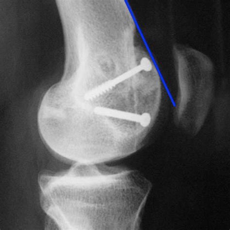 Ct Scan It Directly Evaluates The Trochlear Prominence The Download Scientific Diagram
