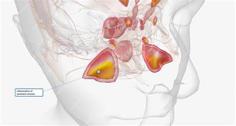 Premium Photo Sinusitis Is An Infection Characterized By Inflammation Of The Paranasal Sinuses