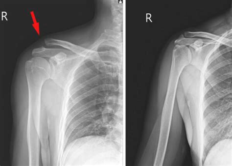 Acromioclavicular Joint Dislocation X Ray