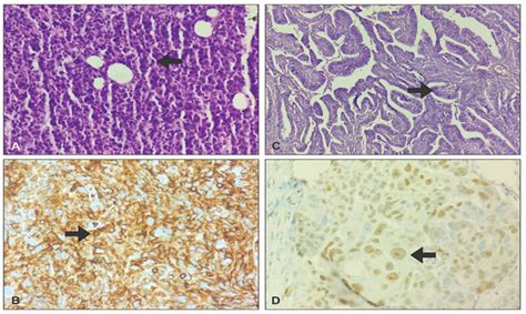 Hematoxylin And Eosin Hande Staining Showing The Sheet Of Atypical