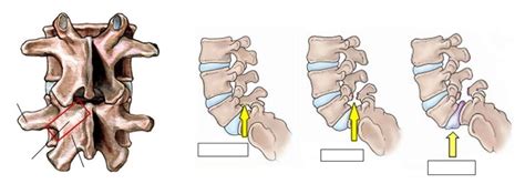 Pars Interarticularis Diagram Quizlet