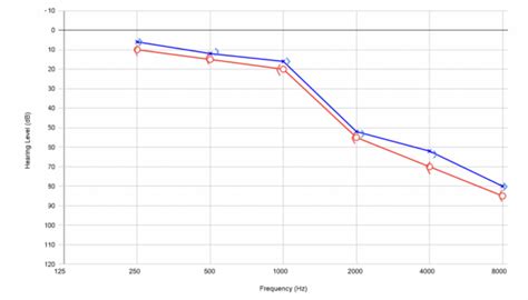 Audiogram Interpretation Reading Audiograms Geeky Medics
