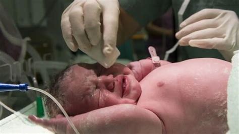 الولادة الطبيعية والولادة القيصرية والفرق بينهما طب 21