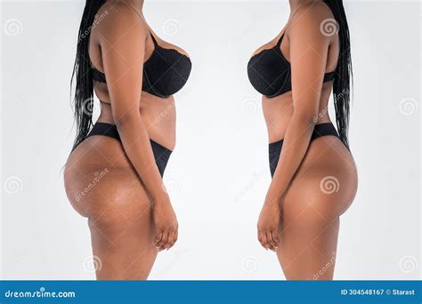 Tummy Tuck Flabby Skin On A Fat Belly Plastic Surgery Concept Stock