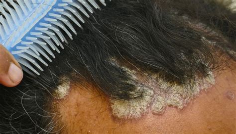 Scalp Rash Main Causes And Itch Relief