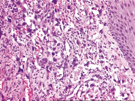 Scalp Angiosarcoma Pleomorphic Malignant Cells Forming Download
