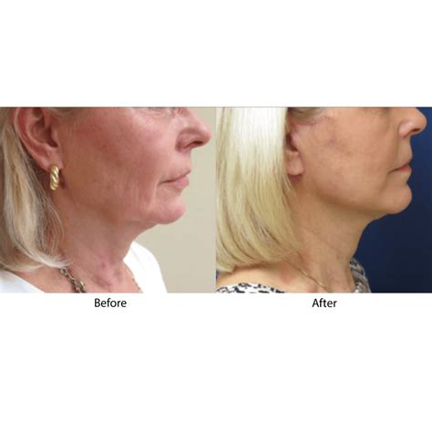 Mini Facelift In Los Altos Transform Your Look With Confidence