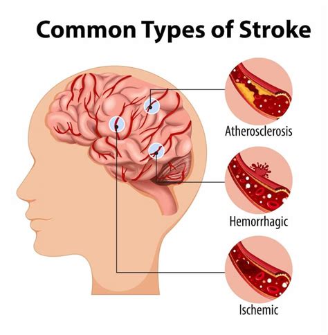 Types Of Ischemic Stroke Independent Ischemic Stroke Risk Factors In